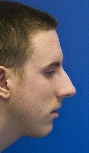 How To Make A Nose Look Smaller With Chin Implantation Seattle Facial Plastic Surgeon Dr 